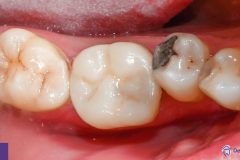 Bev's Porcelain Veneers and Dental Crowns Journey in Sunbury | Diggers ...