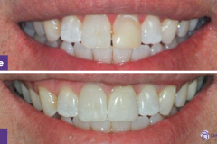 Mitchell’s Porcelain Crown Journey in Sunbury | Diggers Rest Dental House