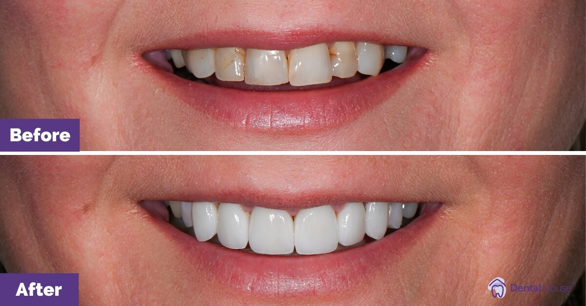 Tooth Restoration Diggers Rest, Taylors Lake Dentist | Inlays & Onlays