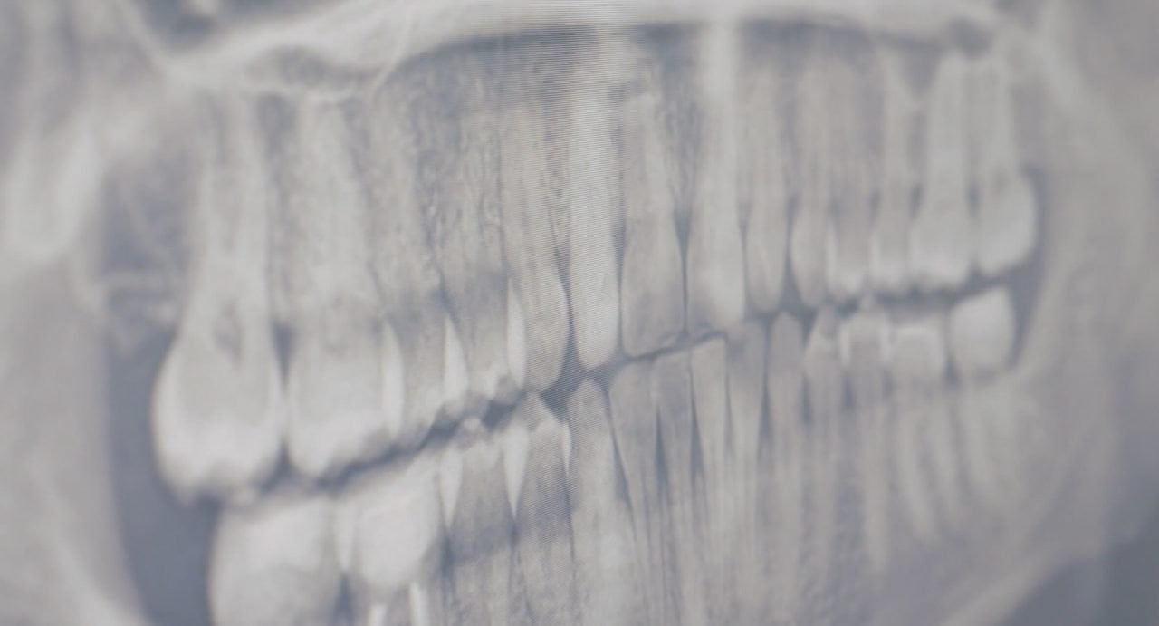 What Happens To Impacted Wisdom Teeth When Left Untreated? | Diggers ...