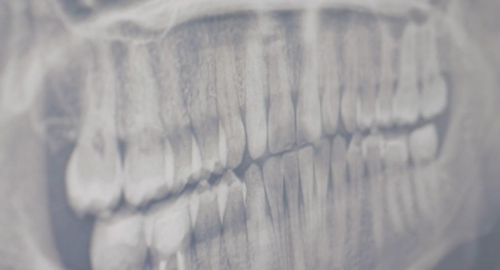 What Happens To Impacted Wisdom Teeth When Left Untreated? | Diggers ...